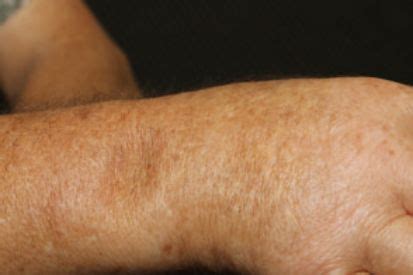 Image result for Scleroderma Skin