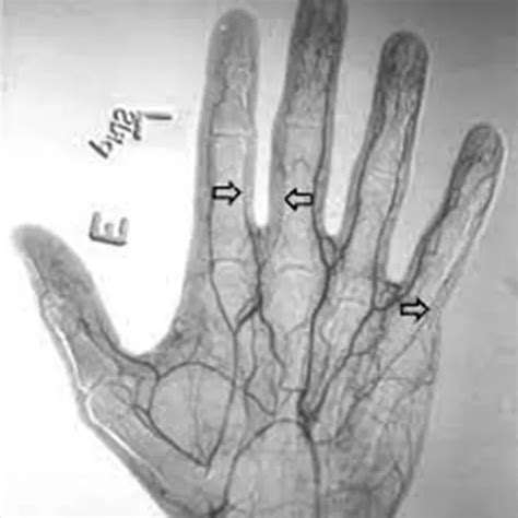 Image result for Hand Angiogram
