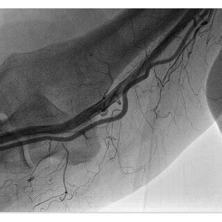 Image result for Angiogram Radial