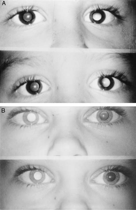 Image result for Red Reflex