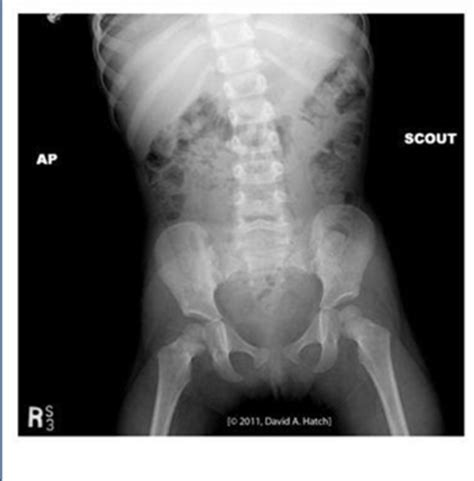 Image result for Cystourethrogram