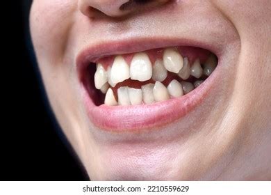 Image result for Wisdom Tooth Overlap