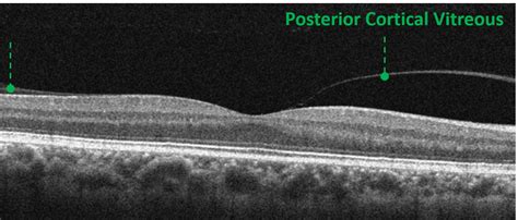 Image result for Oct Retinal Scan Interpretation