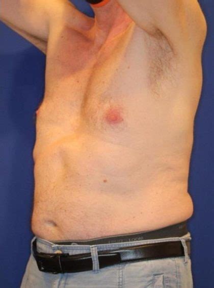 Patient #14231 Body Contouring Before and After Photos New York, NY ...