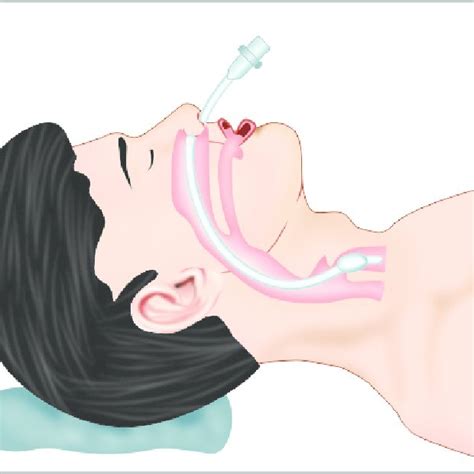 1: Oral tracheal intubation | Download Scientific Diagram