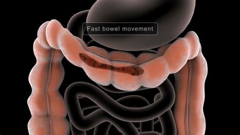 Image result for Straining Bowel Animation