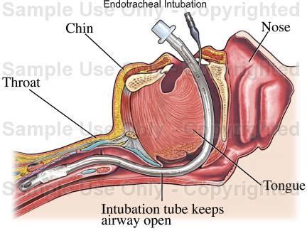 Image result for Intaocular Intubation