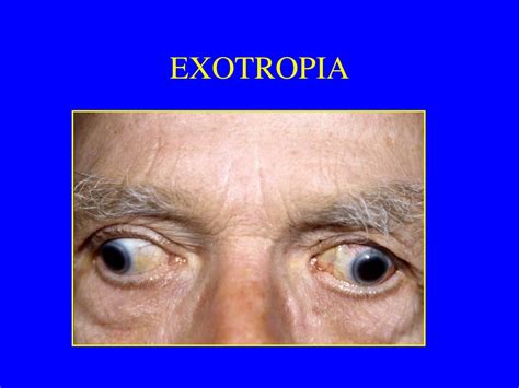 Image result for Exotropia and Computer