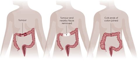Image result for Colon Open Cancer Removal