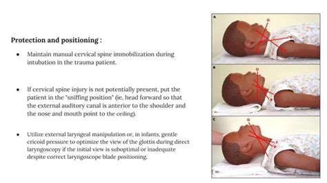 Image result for Real Intubation Procedure