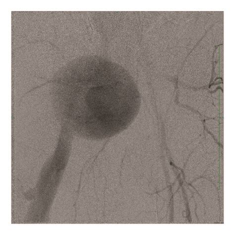 Image result for Left Lower Extremity Angiogram