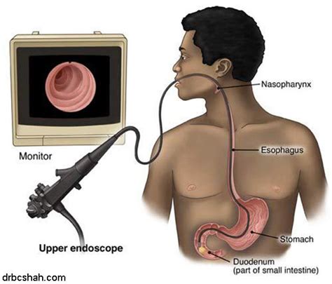 Image result for Endoscopy Small Intestine