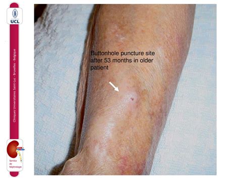 Image result for Buttonhole Invagination