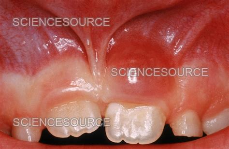 Image result for Exploding Cyst and Abscess