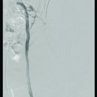 Image result for Left Lower Extremity Angiogram