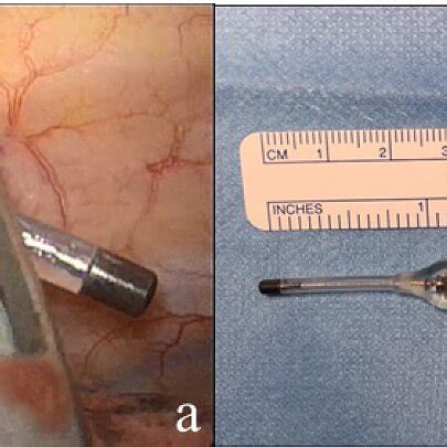 Image result for Left Chest Wall Loop Recorder