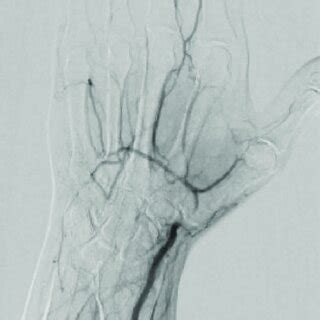 Image result for Angiogram Radial