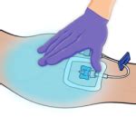 Image result for IV Line Infiltration