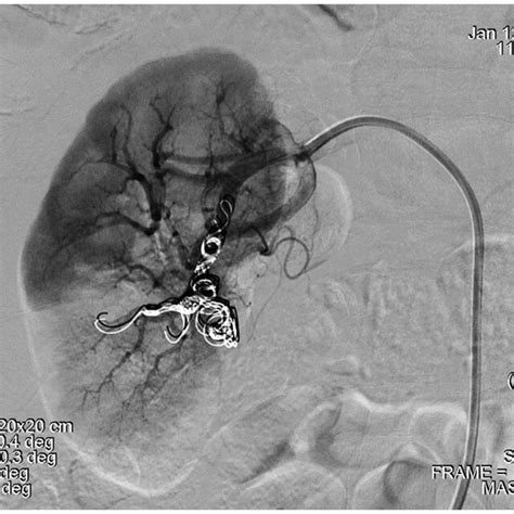 Image result for Angiogram with Embolization