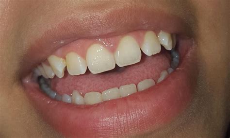 Image result for DIY Front Tooth Chip Repair Kit