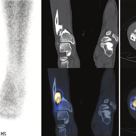 Image result for Triple Phase Bone Scan