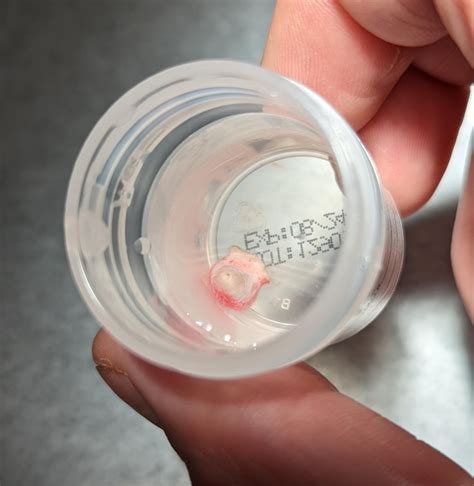 Image result for Upper-Back Cyst Surgery