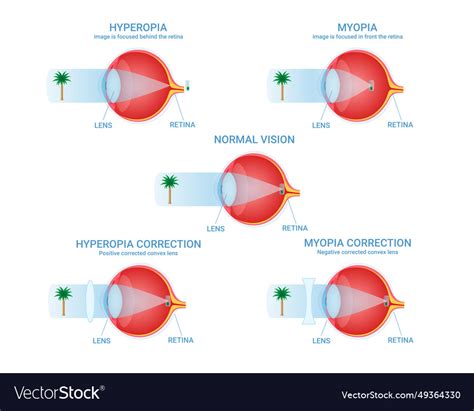 Image result for Vision Defects Myopia