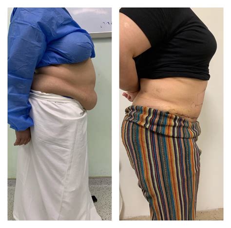 Image result for Body Contouring Surgery