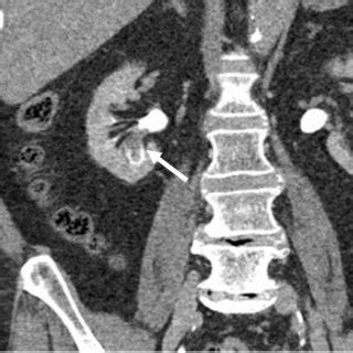 Image result for Delayed Phase CT Urogram
