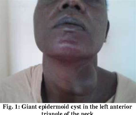 Image result for Big Exploding Cyst Neck