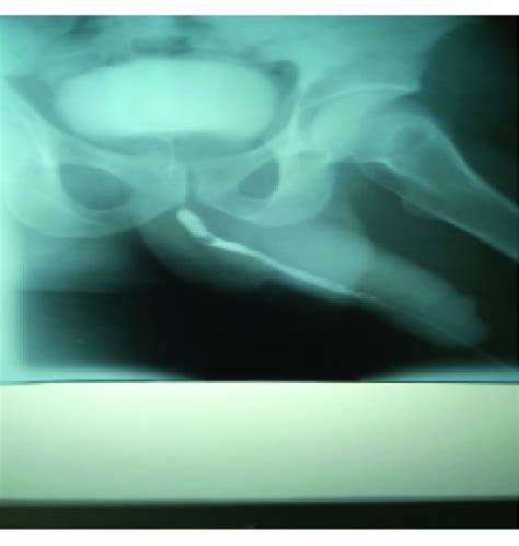 Image result for Urethrogram Procedure