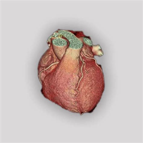 Image result for Normal Coronary CT Angiogram