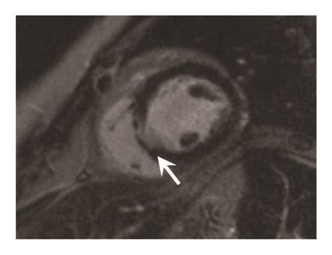 Image result for Normal Coronary Angiogram