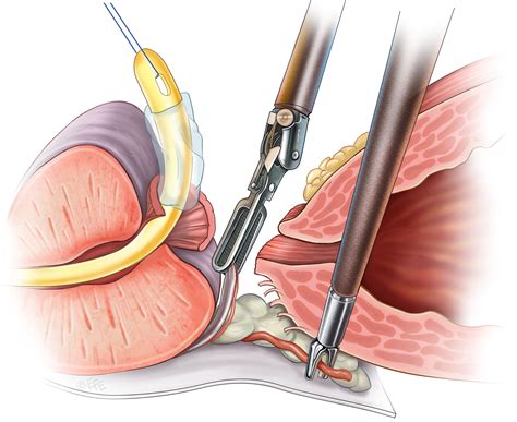 Image result for Robotic Prostatectomy Procedure