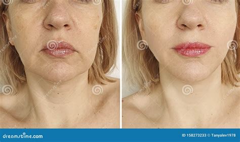 Image result for Thread Lifting Face