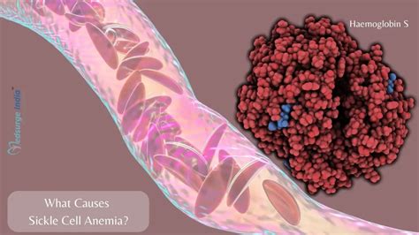 Image result for Sickle Cell Anemia Explained