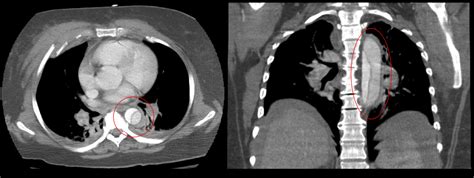 Image result for Type 2 Aortic Dissection