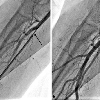 Image result for Radial Loop Angiogram