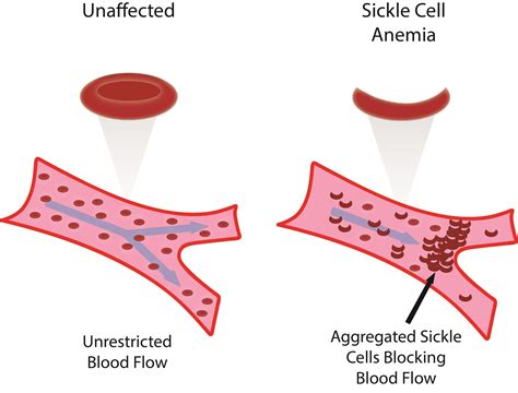 Image result for Sickle Cell Anemia Explained