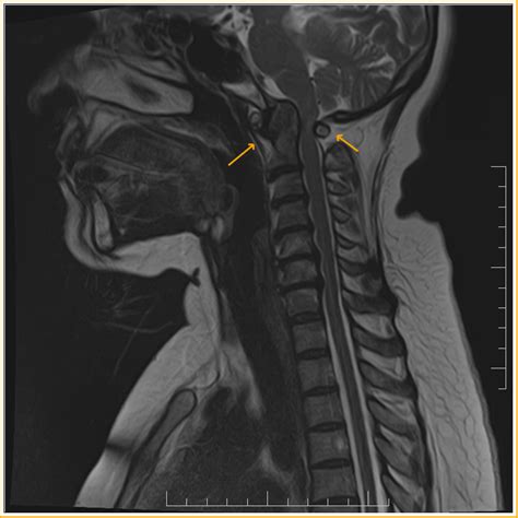 Image result for X-Rays for Basilar Invagination