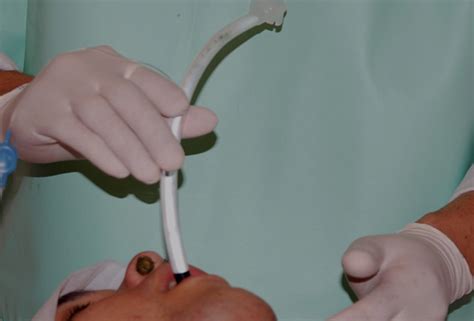 Image result for Intubation Procedure