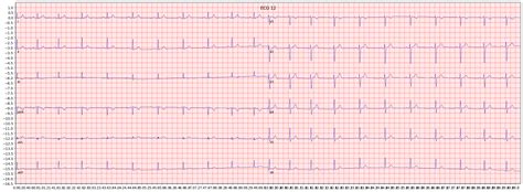 Examples of Normal ECG (NORM) | ECG Library