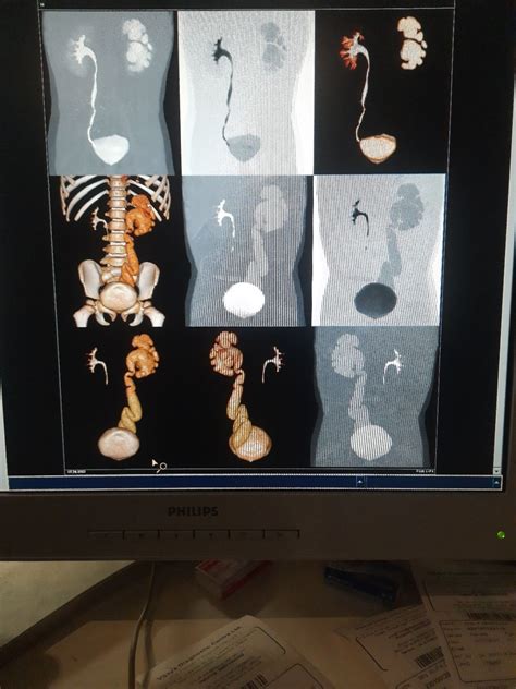 Image result for Delayed Phase Contrast CT Urogram