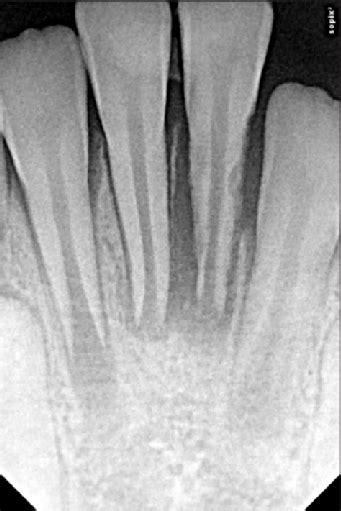 Avulsed tooth (tooth #31) four weeks after replantation. Periapical ...