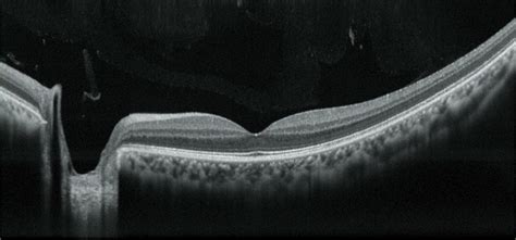 Image result for Oct Retinal Scan