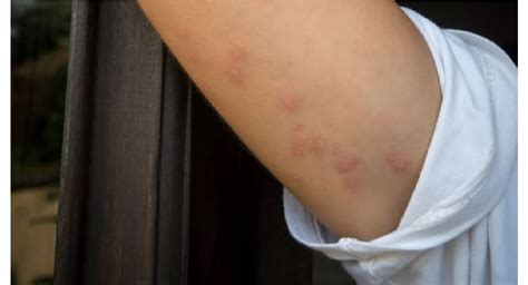 Image result for Cockroach Bites On Humans