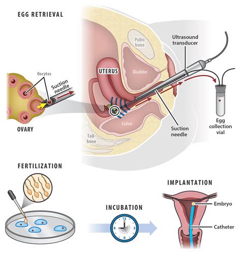 Image result for In Vitro Fertilization Procedure Step by Step