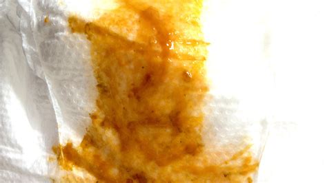 Image result for Yellow Stool Poop