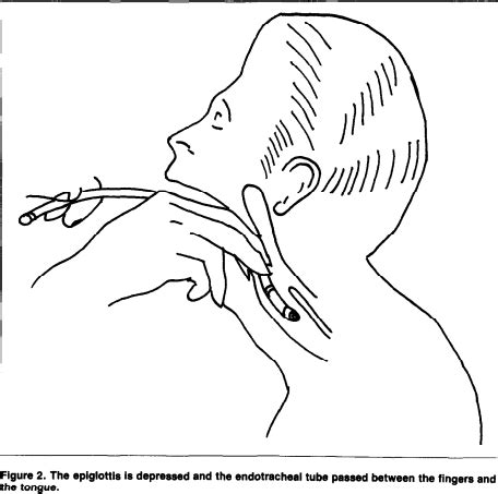 Image result for Digital Intubation