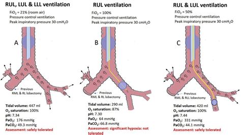 Image result for Bronchial Challenge Test Procedure